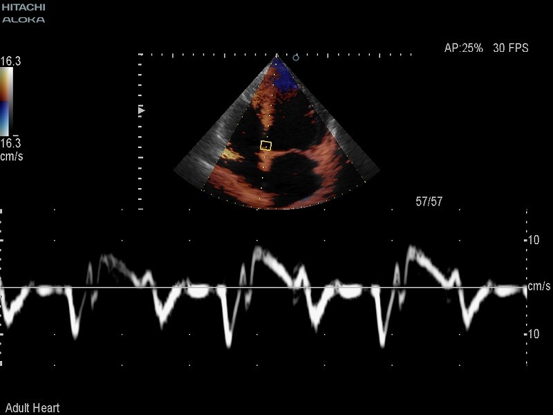 HITACHI ARIETTA V60 | MEDtechnic services s.r.o.